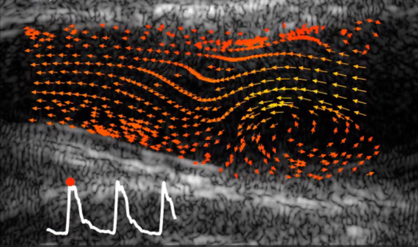 High-tech imaging improves post-surgery treatment of carotid artery ...